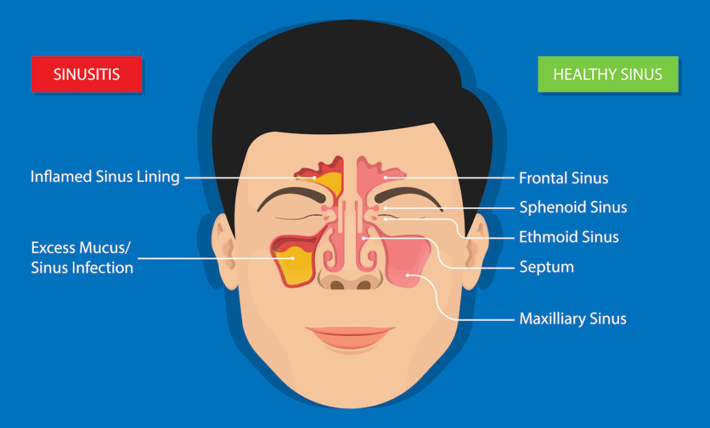 Medicinale wiet bestrijdt symptomen van sinusitis (bijholteontsteking ...