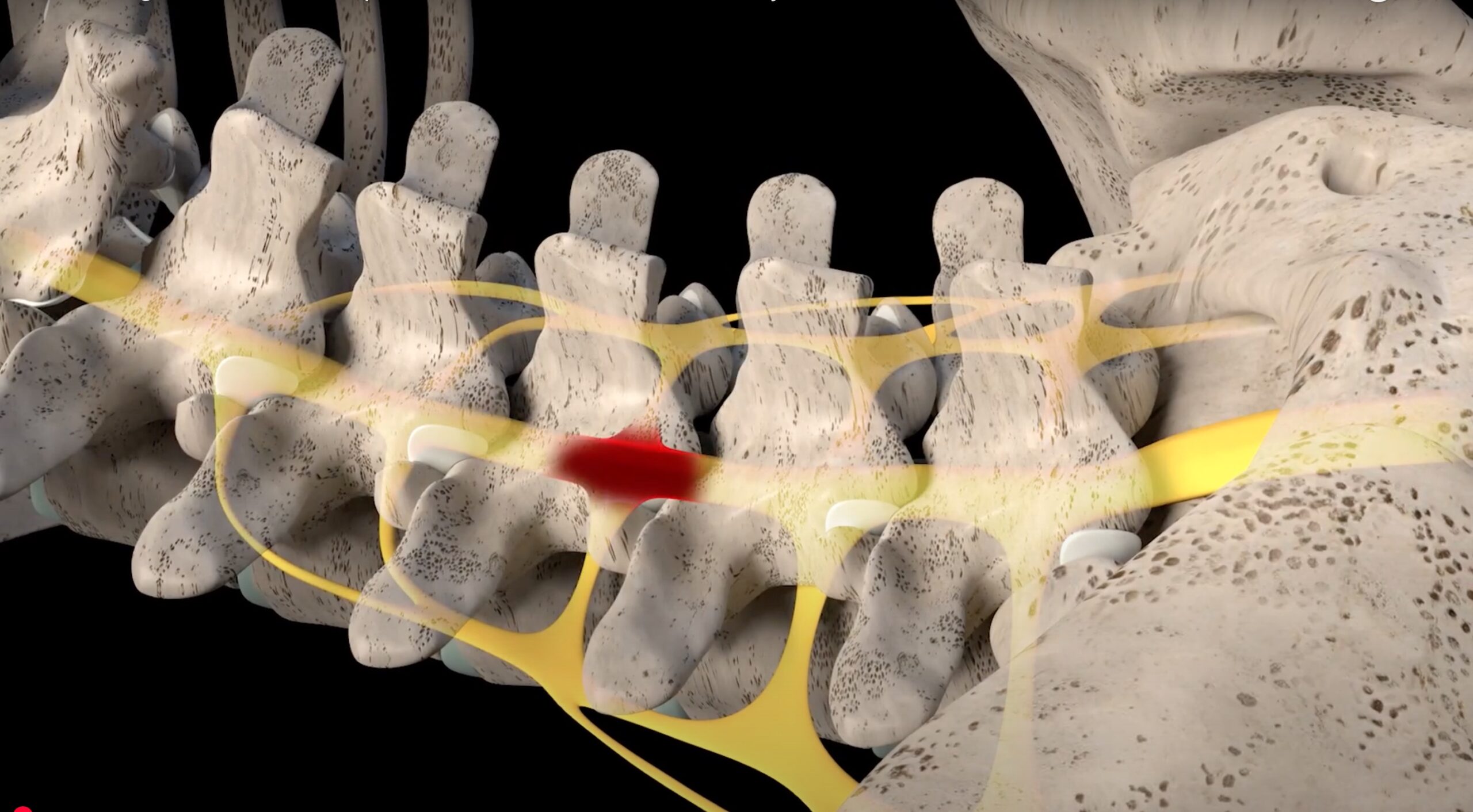 Max kan dankzij cannabis leven met blootliggende zenuwen in rug ...